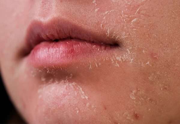 Peeling Skin On Face: Top Common Causes And Solutions | Plix